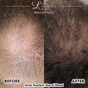 Hair Restoration | Lébo Aesthetics & Spa | York & Hanover PA