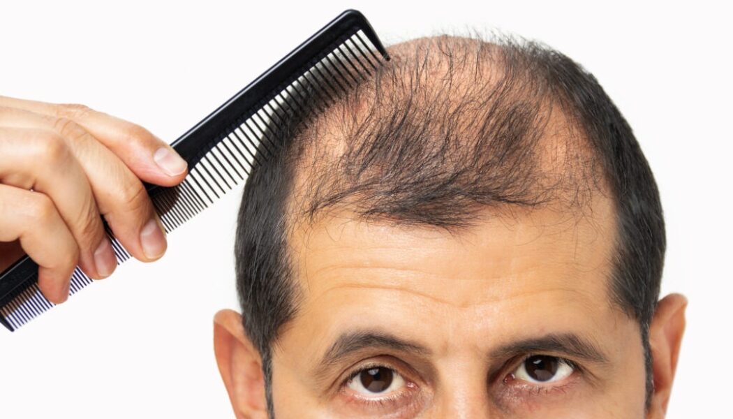 Understanding Hair Loss and Exploring Restoration Options | Lébo ...